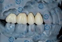 China Yucera Cad Cam 4D Pro Multilayer Super Zir 98 Open System Crown Dental Laboratory Dental Zirconia Block for sale