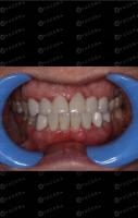 China Yucera ST color Dental Zirconia Blocks Your Trusted Choice for Lifelike Dental Restorations for sale