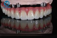 China Dental 3D Multilayer Zirconia Block For Dental Esthetic Restoration for sale