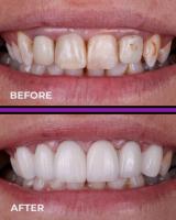 China CE 49% Transmittance Zirconia Blocks Dental Discs For Aesthetic Restoration for sale