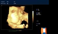 China Medical Ultrasound Device 4D Portable Color Doppler Machine for sale
