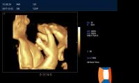 China Medical Ultrasound Device 4D Portable Color Doppler Machine for sale