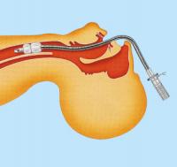 China Stainless Steel Laser Resistant Endotracheal Tube 4.5mm ID for Laser Surgery for sale
