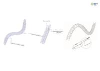 China Accurate Placement Urs Dj Stent Radio Opaque Marker Nitinol Frame for sale