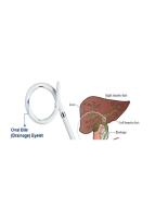 China Standard Pigtail Loop Biliary Drainage Catheter External Biliary Drainage with Platinum Marker One Click Lock for sale