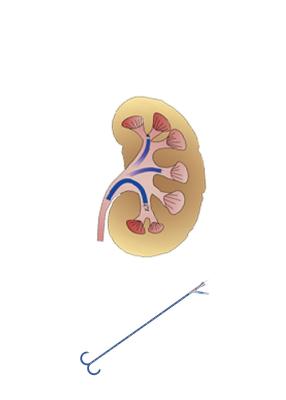 China High Value Ureteral Access Sheath Endourology Practices Access Sheath Urology for sale