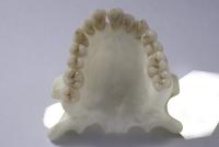 China Precise Bar Implant Supported Hybrid Denture Comfortable Fit Replace Missing Teeth for sale