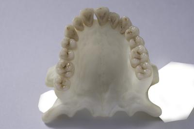 China Precise Bar Implant Supported Hybrid Denture Comfortable Fit Replace Missing Teeth for sale