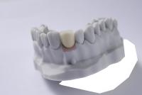 China Customized Bar Retained Implant Overdenture Over Implant Bar With Preci Attachments for sale