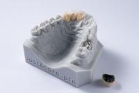 China Customized Bar Retained Implant Overdenture Over Implant Bar With Preci Attachments for sale