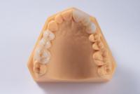 China Custom Made Zirconia Dental Crown Replace Missing Teeth For Effective Restoration for sale