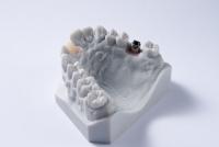 China Presicion Fit Implant Supported Dentures Implant Bar With Locator Attachments for sale