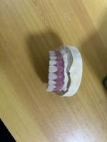 China Customized Long Lasting Implant Retained Dentures For Dental Prosthetics for sale