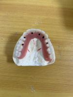 China Customized Long Lasting Implant Retained Dentures For Dental Prosthetics for sale