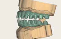 China Bonded Wire Orthodontic Retainer Permanent CAD CAM Fabrication For Teeth Alignment for sale