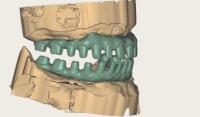 China Bonded Wire Orthodontic Retainer Permanent CAD CAM Fabrication For Teeth Alignment for sale