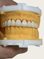 China Layered Zirconia Dental Crowns With Porcelain Fused To Metal High Esthetic For Clinics for sale