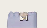 China Natural Looking Biocompatible Dental Implant Crown Bridge For Dental Restoration for sale