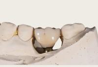 China Screw Retained Dental Implant Crowns PFZ Porcelain Layered Dental Zirconia Crown for sale