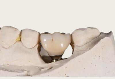 China Screw Retained Dental Implant Crowns PFZ Porcelain Layered Dental Zirconia Crown for sale