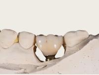 China Screw Retained Dental Implant Crowns PFZ Porcelain Layered Dental Zirconia Crown for sale