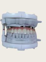 China High Accuracy Dental Implant Crown And Bridge For Natural Tooth Contour Enhancing for sale