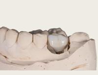 China Screw Retained Dental Implant Crowns PFZ Porcelain Layered Dental Zirconia Crown for sale