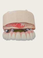 China Dental Implant Metal Ceramic Bridges Titanium Abutments CAD CAM High Precision for sale
