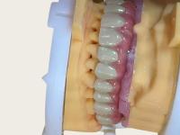 China Customized Dental Implant Crown Bridge Tibase Zirconia Abutments Accurate Fit for sale