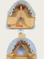 China Customized Dental Implant Crown Bridge Tibase Zirconia Abutments Accurate Fit for sale