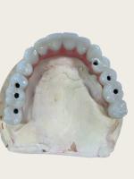 China High Accuracy Dental Implant Crown And Bridge For Natural Tooth Contour Enhancing for sale