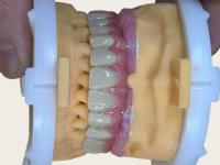 China Customized Dental Implant Crown Bridge Tibase Zirconia Abutments Accurate Fit for sale