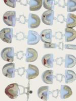 China Zirconia Dental Implant Crowns Titanium CAD CAM Abutments For Tooth Restoration for sale