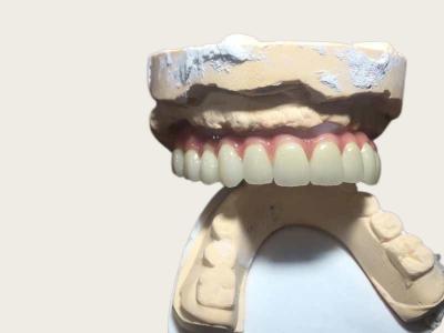 China High Accuracy Esthetic Full Zirconia Bridge With Titanium Bar Screwed Retained for sale