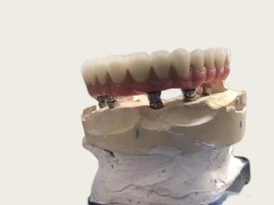 China Full Zirconia Bridge With Titanium Bar Support Full Arch Solutions Comfortable Fit for sale