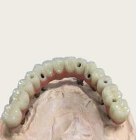 China Full Zirconia Bridge With Titanium Bar Support Full Arch Solutions Comfortable Fit for sale