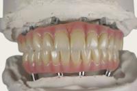 China Innovative Implant Hybrid Bridge Implant Supported Hybrid Bridge For Dental Restoration for sale