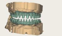 China Innovative Implant Hybrid Bridge Implant Supported Hybrid Bridge For Dental Restoration for sale
