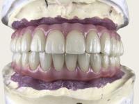 China Innovative Implant Hybrid Bridge Implant Supported Hybrid Bridge For Dental Restoration for sale