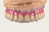 China High Accuracy Esthetic Full Zirconia Bridge With Titanium Bar Screwed Retained for sale