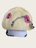 China High Accuracy Dental Lab Telescopic Crowns Natural Looking Custom Shape for sale