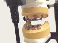 China High Accuracy Dental Lab Telescopic Crowns Natural Looking Custom Shape for sale