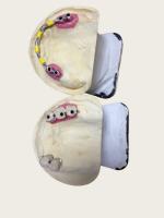 China Precision Fit Attachment Partial Denture Long Lasting Dental Precision Attachments for sale