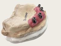 China CAD CAM Tooth Combination Dentures Secure Fit Easy Maintenance Partial Dentures for sale