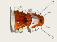 China Adjustable Comfortable Teeth Palate Expander CAD CAM Orthodontic Dental Appliance for sale