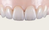 China Dental Full Mouth Zirconia Bridge High Translucency Precision Fit Staining Resistant for sale