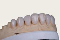 China Dental Full Mouth Zirconia Bridge High Translucency Precision Fit Staining Resistant for sale