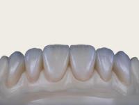 China Dental Full Mouth Zirconia Bridge High Translucency Precision Fit Staining Resistant for sale