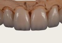 China Dedicated Dental Laboratory Laminates And Veneers Customized Esthetic Restorations for sale