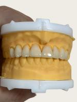 China Dental Lab Emax Laminate Veneers High Esthetic Teeth Veneers Natural Appearance for sale